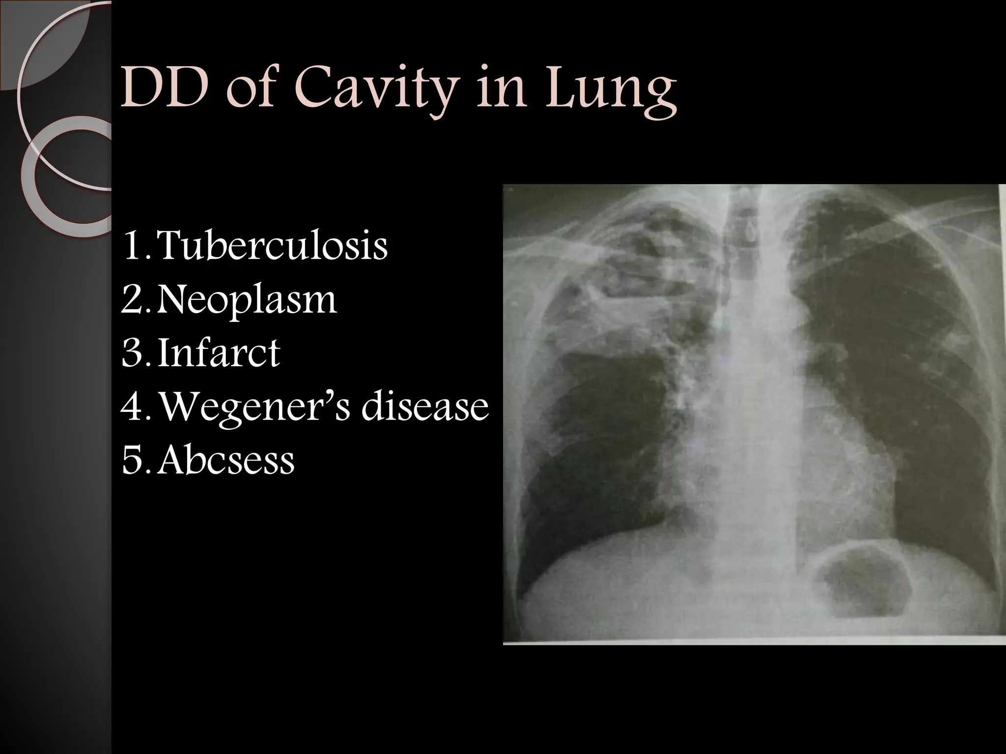 Clinical features investigation of pulmonary tb | PPT