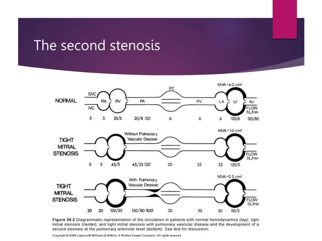 clinical hemodynamics in Mitral stenosis | PPT