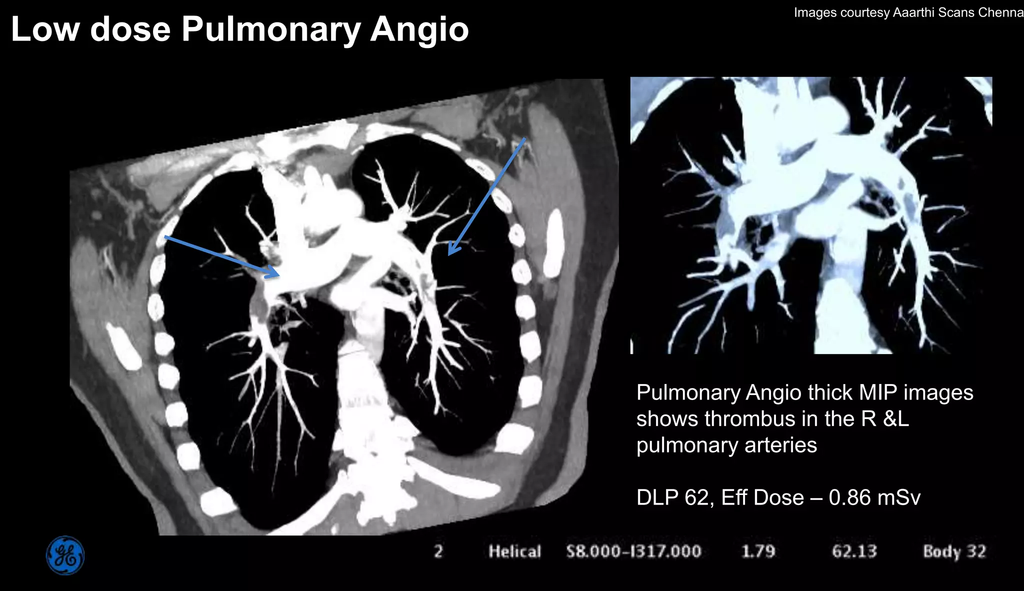 GE Healthcare Revolution ACT EX Clinical Image Gallery | PPT