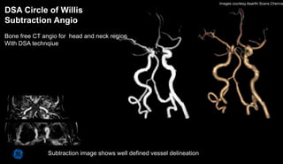 GE Healthcare Revolution ACT EX Clinical Image Gallery | PPT