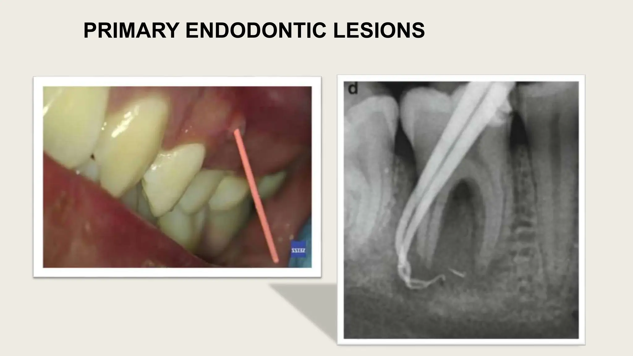 CLINICAL IMPLICATIONS OF ENDOPERIO LESIONS.pptx