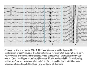 clinical interpretation of eeg and disease based interpretation .pptx