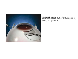 Clinical Management of Aphakia and Pseudophakia.pptx