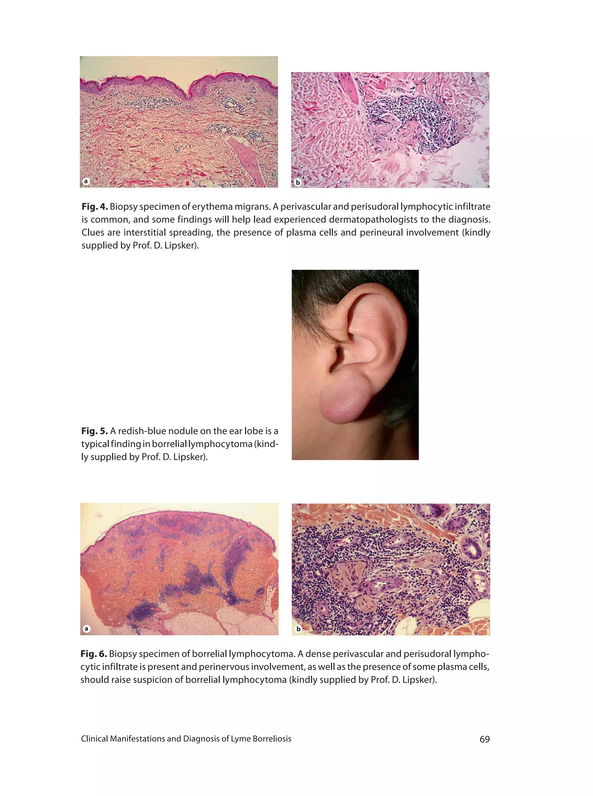 Clinical manifestations & diagnosis of lyme borreliosis | PDF
