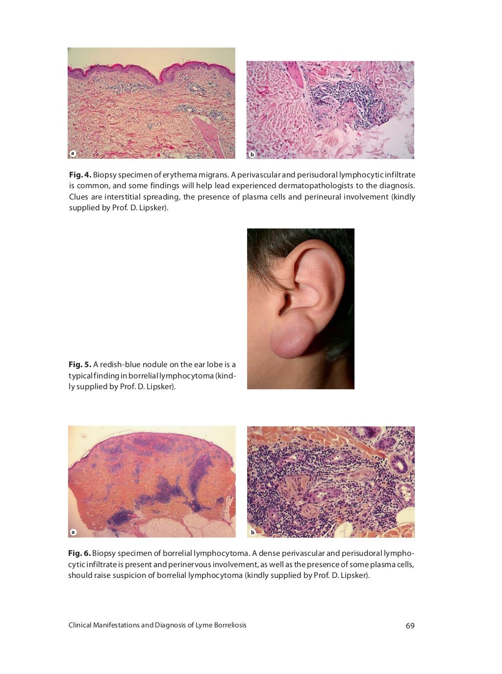 Clinical manifestations & diagnosis of lyme borreliosis Clinical manifestations & diagnosis of lyme borreliosis
