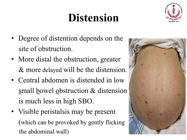 Clinical Manifestations of Intestinal Obstruction (Constipation) | PPTX