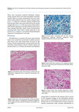 Elastofibroma: A Soft Tissue Infiltrative Lesion Revealing the ...