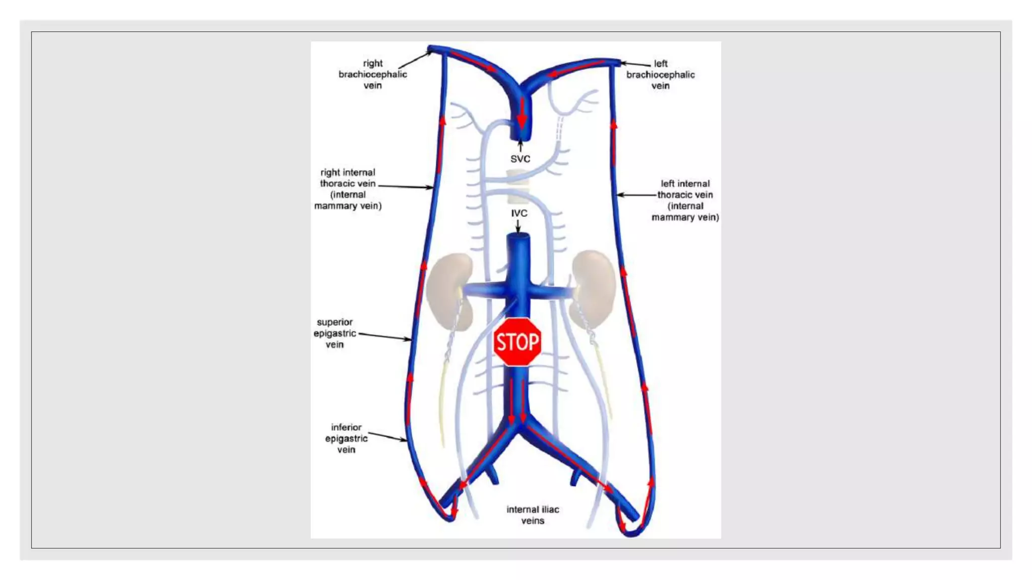CLINICAL MEET IVC thrombosis.pptx