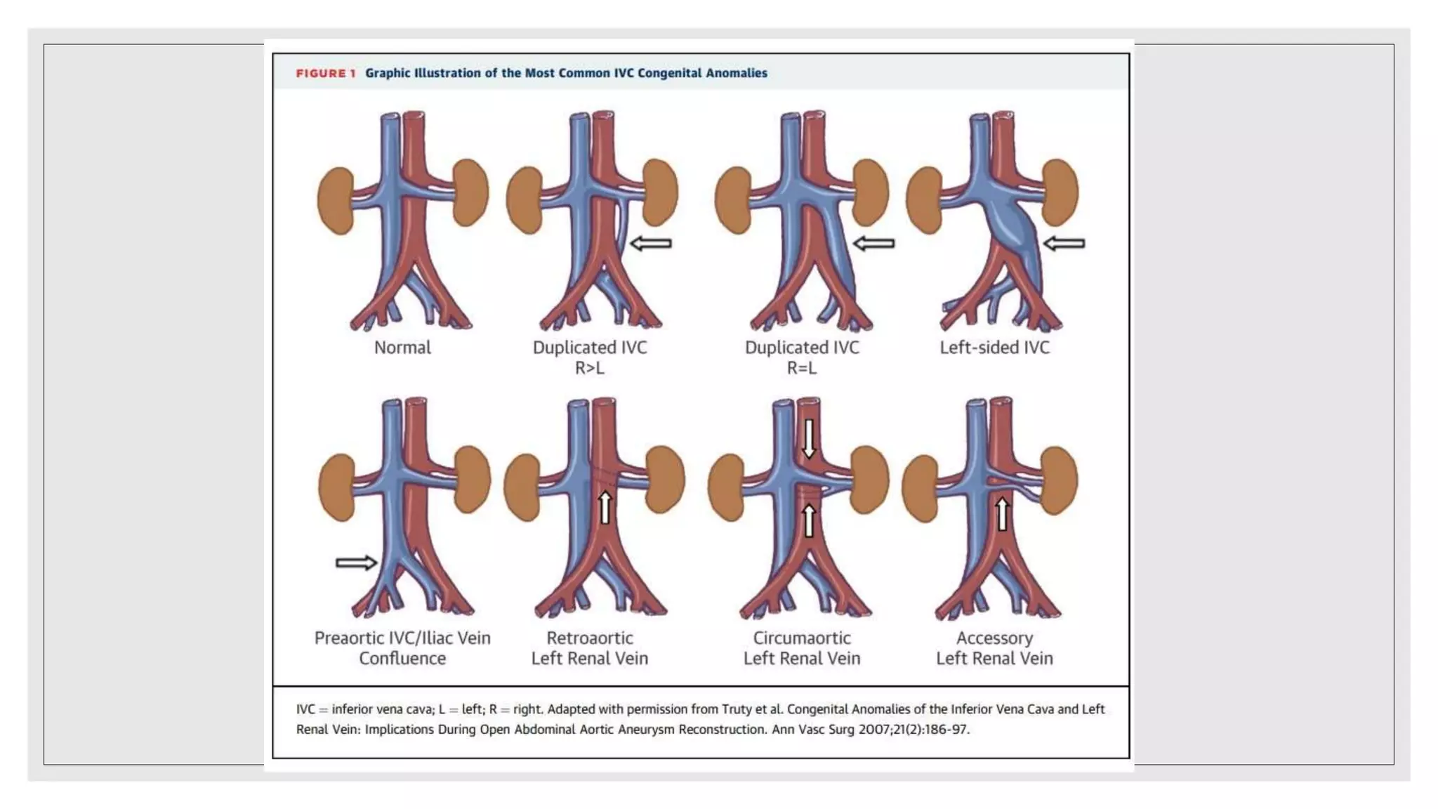 CLINICAL MEET IVC thrombosis.pptx
