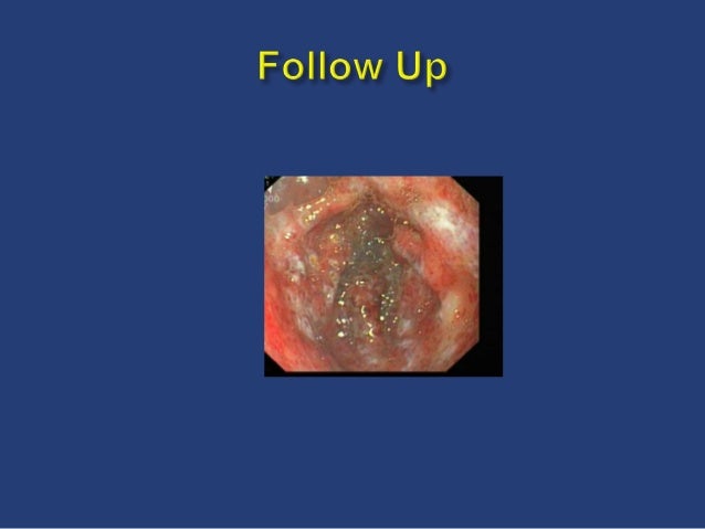 GASTRIC ANTRAL VASCULAR ECTASIA
