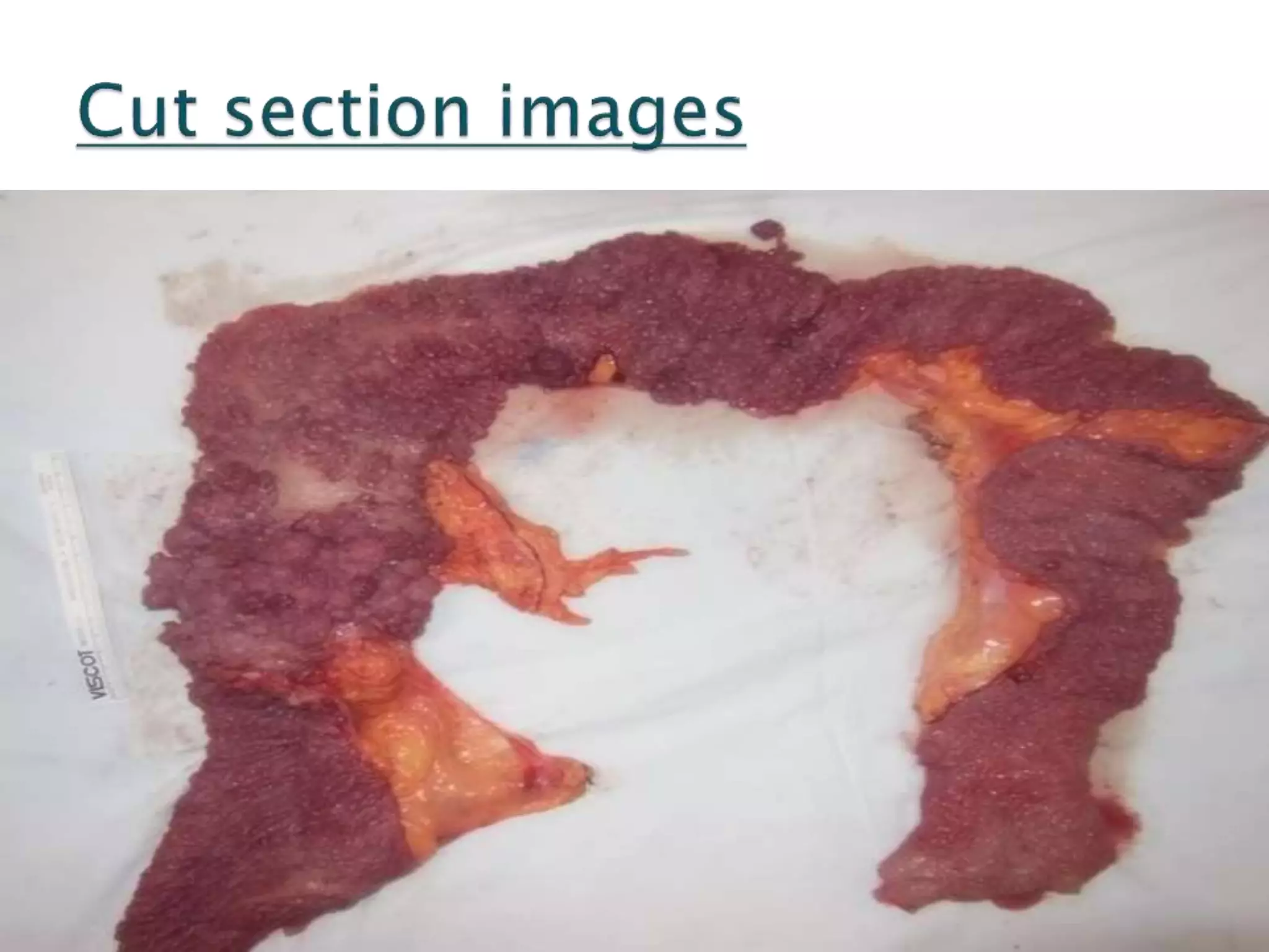 familial adenomatous polyposis | PPTX