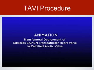 Clinical needs finding presentation tavi | PPT
