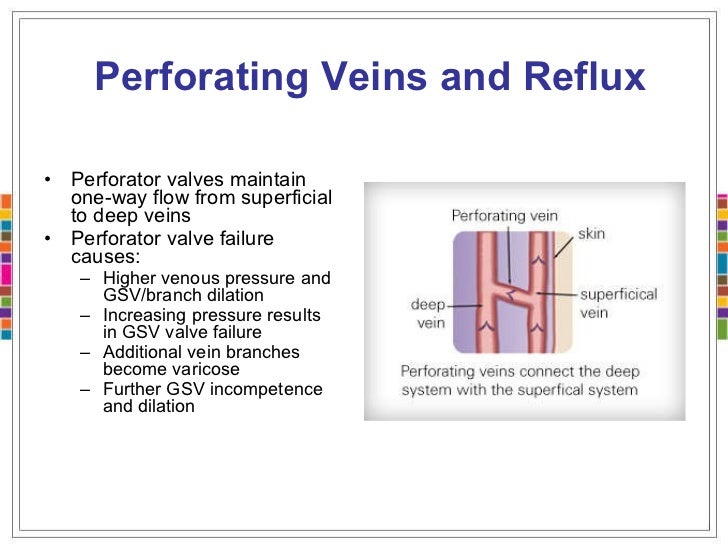Venous Insufficiency