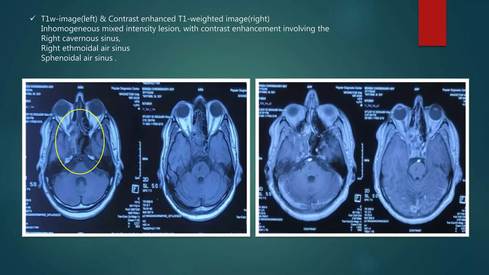 Case presentation on Cavernous sinus thrombosis | PPTX