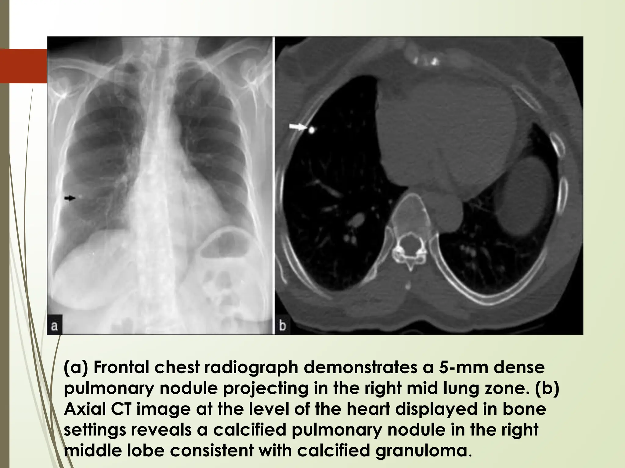 CLINICAL PRESENTATION ,DIAGNOISIS AND STAGING OF LUNGCANCER.pptx.pptx