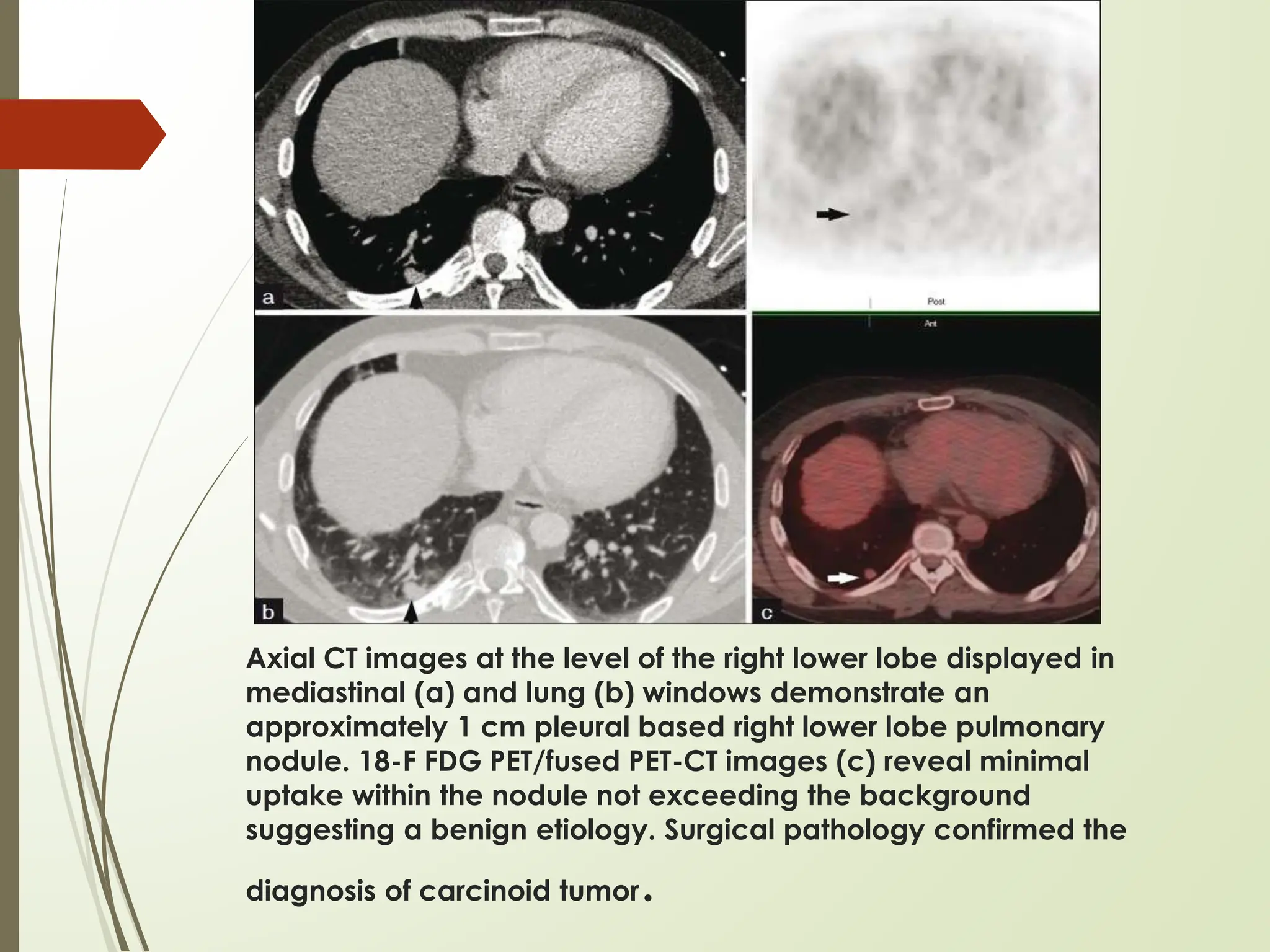 CLINICAL PRESENTATION ,DIAGNOISIS AND STAGING OF LUNGCANCER.pptx.pptx