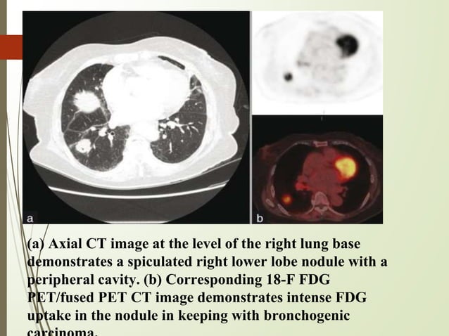 CLINICAL PRESENTATION ,DIAGNOISIS AND STAGING OF LUNGCANCER.pptx.pptx