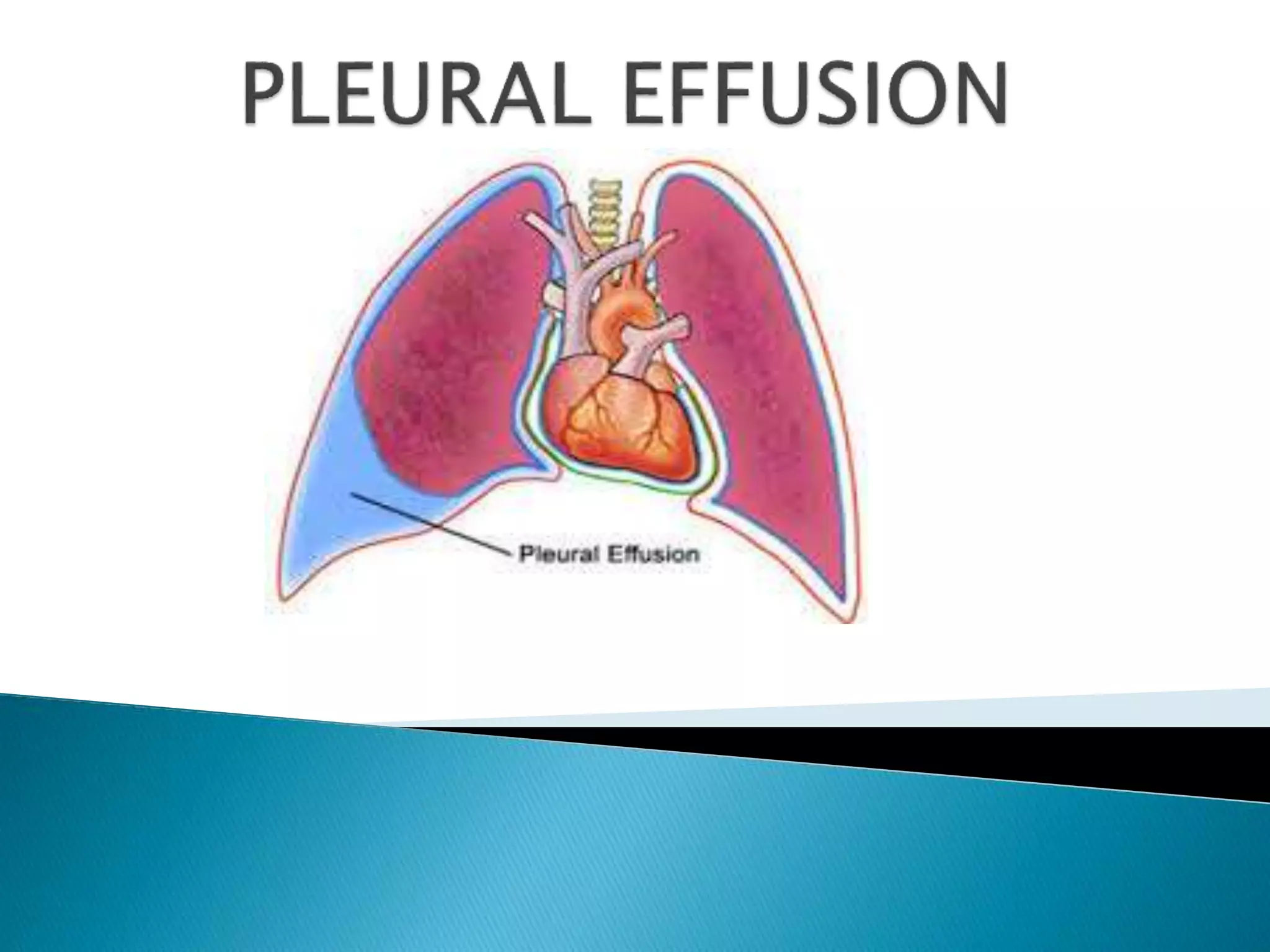 Clinical presentation of a patient with pleural effusion | PPTX