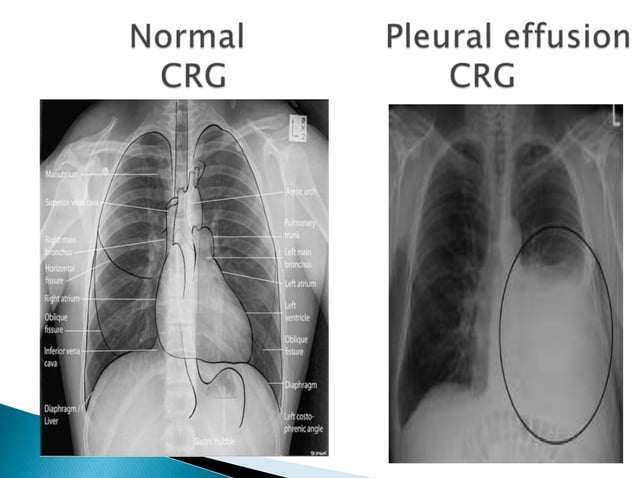 Clinical presentation of a patient with pleural effusion | PPTX