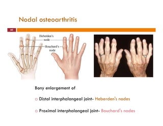 Clinical presentation on Osteoarthritis (Sandhi Gata Vata) | PDF