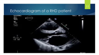 A case study based Clinical presentation on RHD.pptx