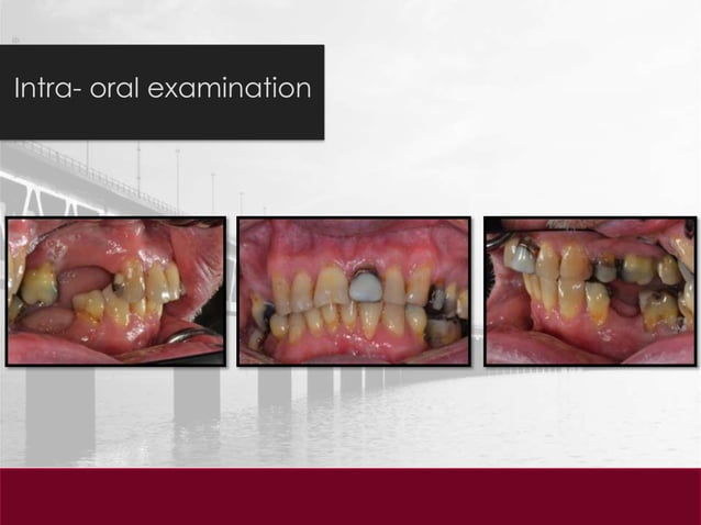 Dental clinical case presentation | PPTX | Oral care | Personal Care