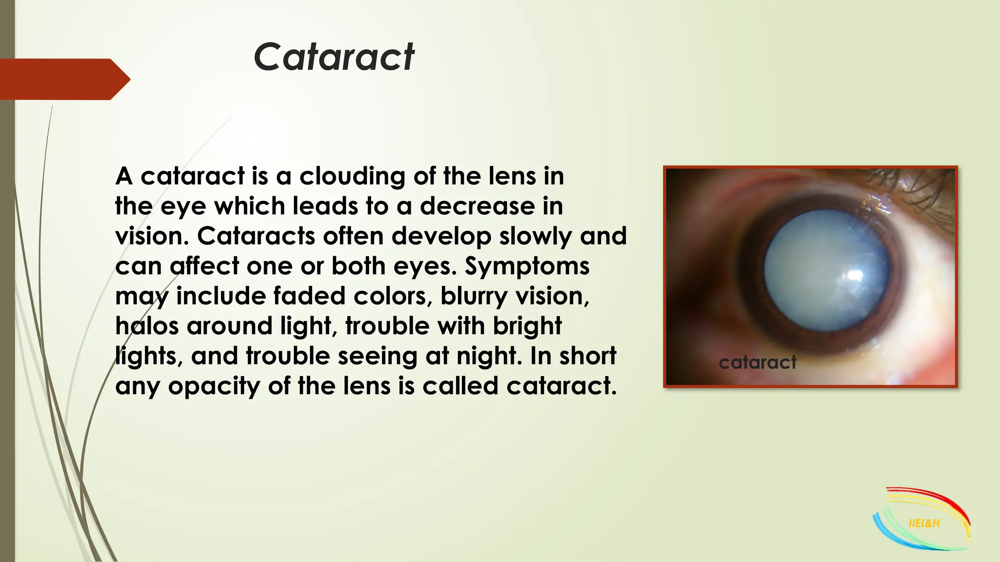 CLINICAL Presentaton OF CATARACTS-4.pptx | Free Download