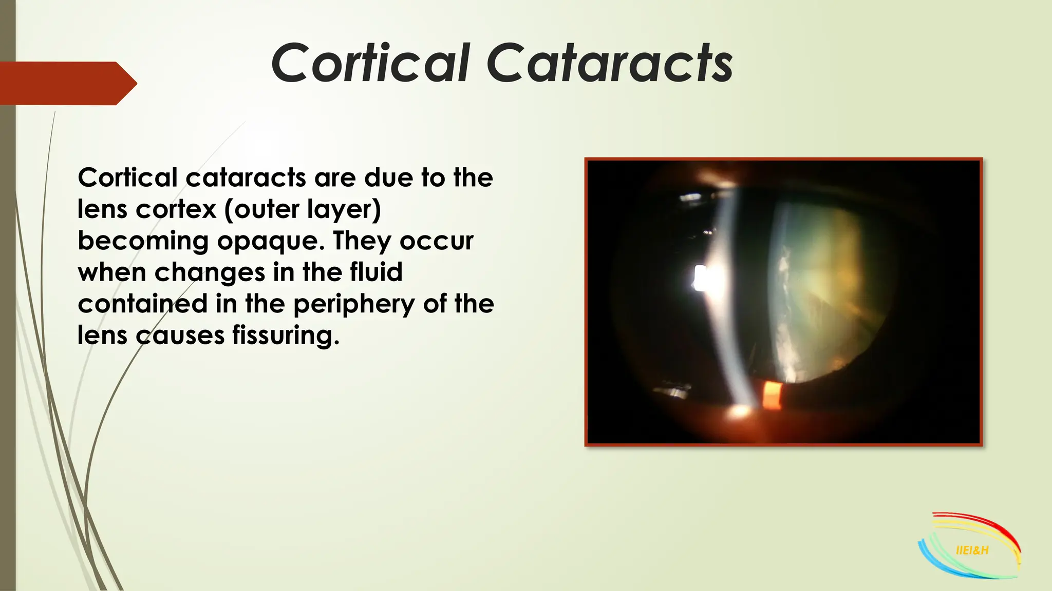 CLINICAL Presentaton OF CATARACTS-4.pptx