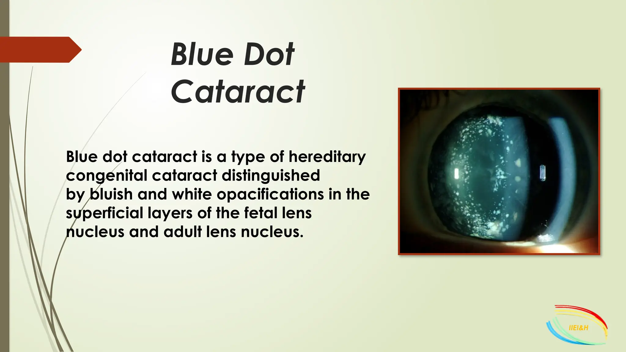 CLINICAL Presentaton OF CATARACTS-4.pptx