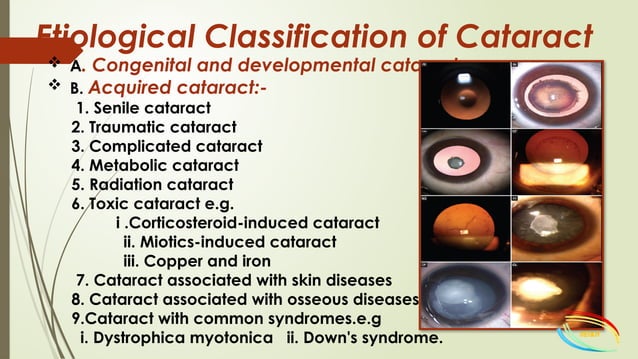 CLINICAL Presentaton OF CATARACTS-4.pptx