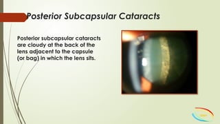 CLINICAL Presentaton OF CATARACTS-4.pptx