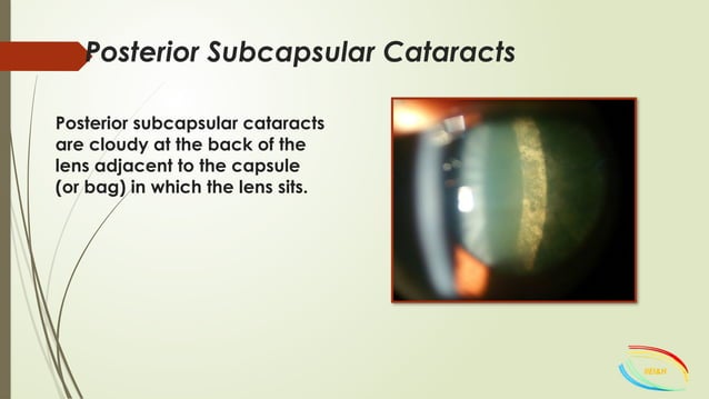 CLINICAL Presentaton OF CATARACTS-4.pptx