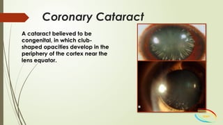 CLINICAL Presentaton OF CATARACTS-4.pptx