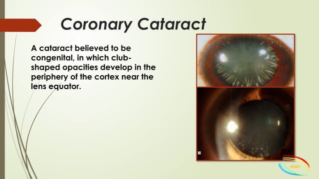 CLINICAL Presentaton OF CATARACTS-4.pptx
