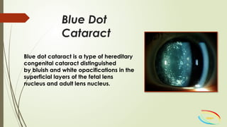 CLINICAL Presentaton OF CATARACTS-4.pptx