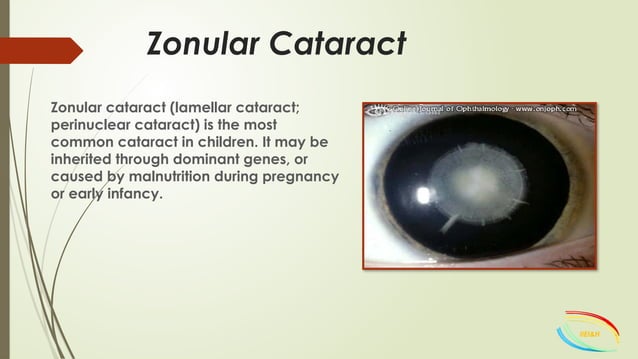 CLINICAL Presentaton OF CATARACTS-4.pptx
