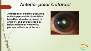 CLINICAL Presentaton OF CATARACTS-4.pptx