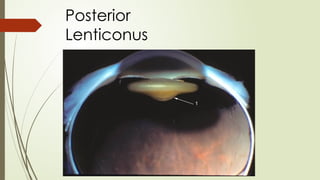 CLINICAL Presentaton OF CATARACTS-4.pptx