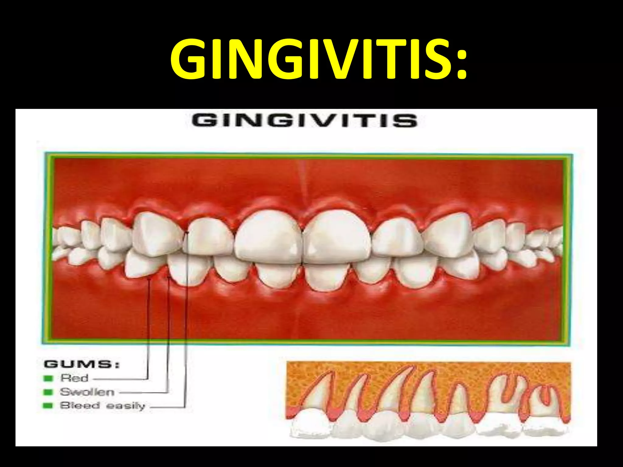 Clinical reatures of gingivitis | PPTX