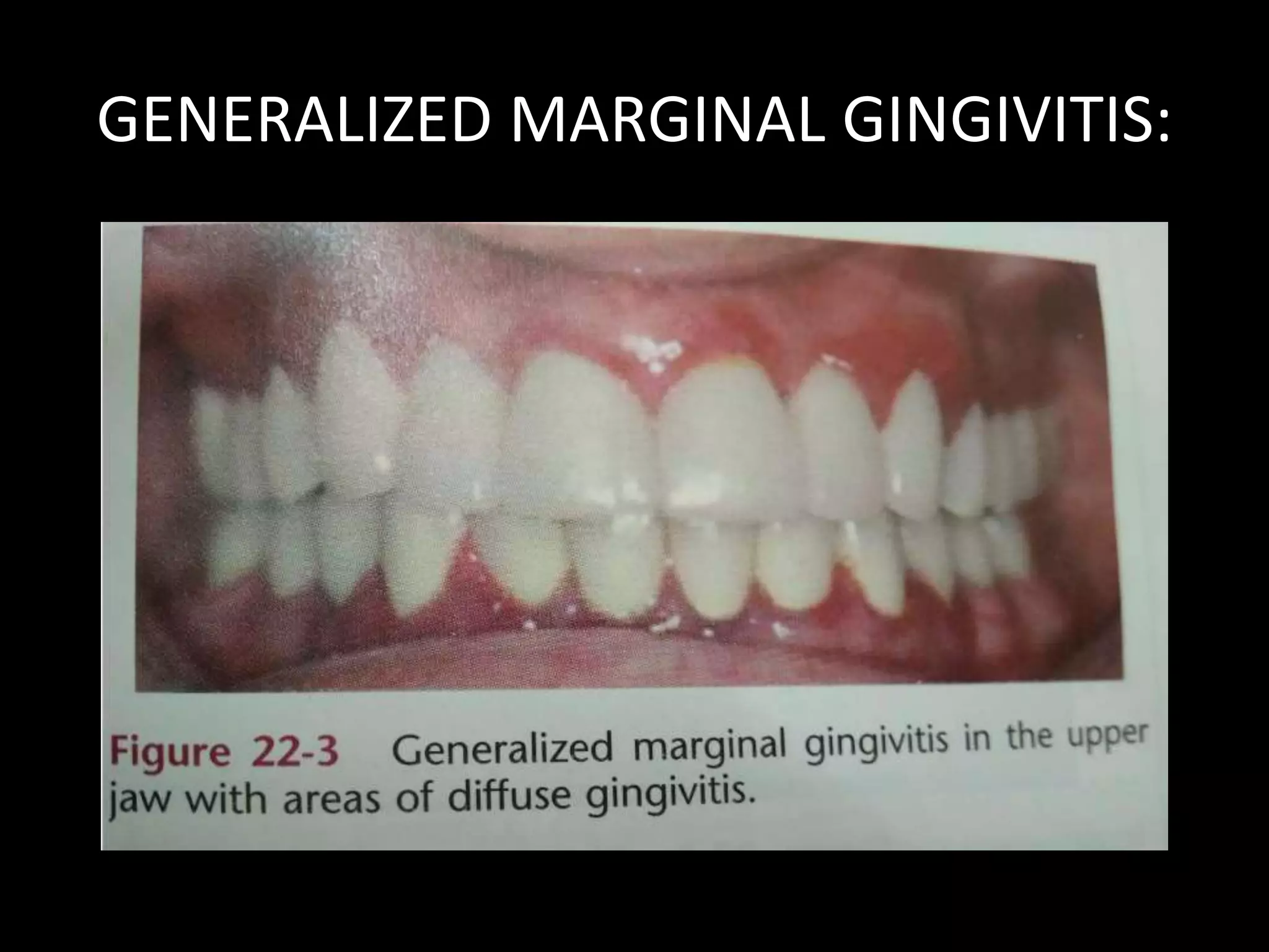 Clinical reatures of gingivitis | PPTX