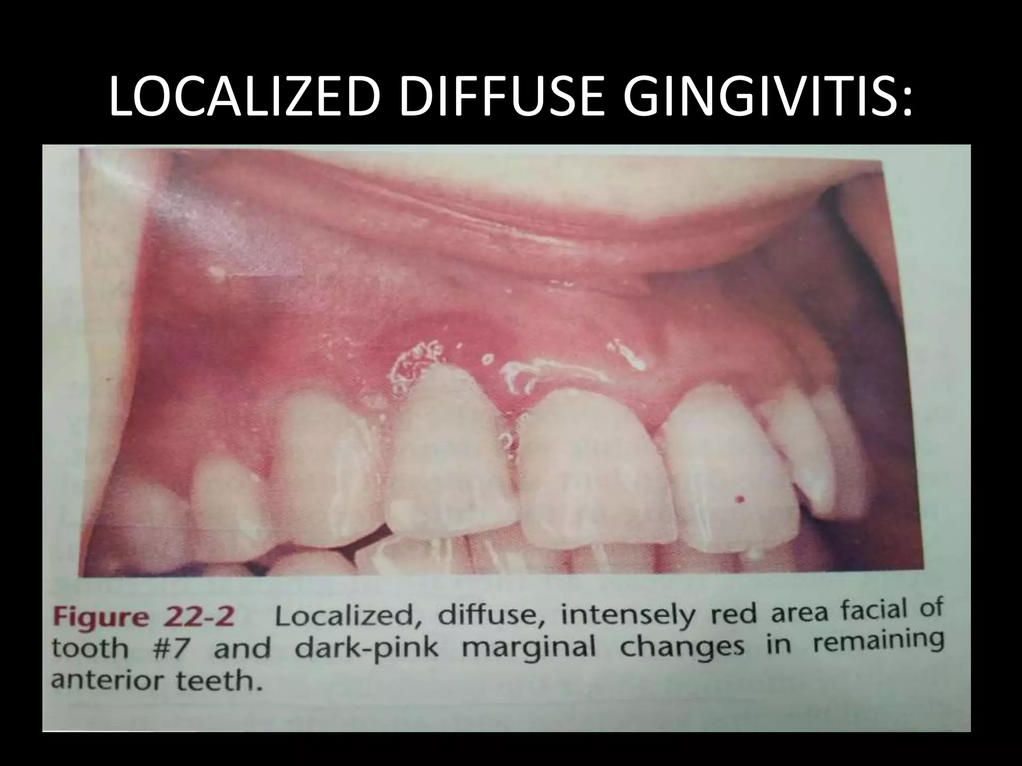 Clinical reatures of gingivitis | PPTX