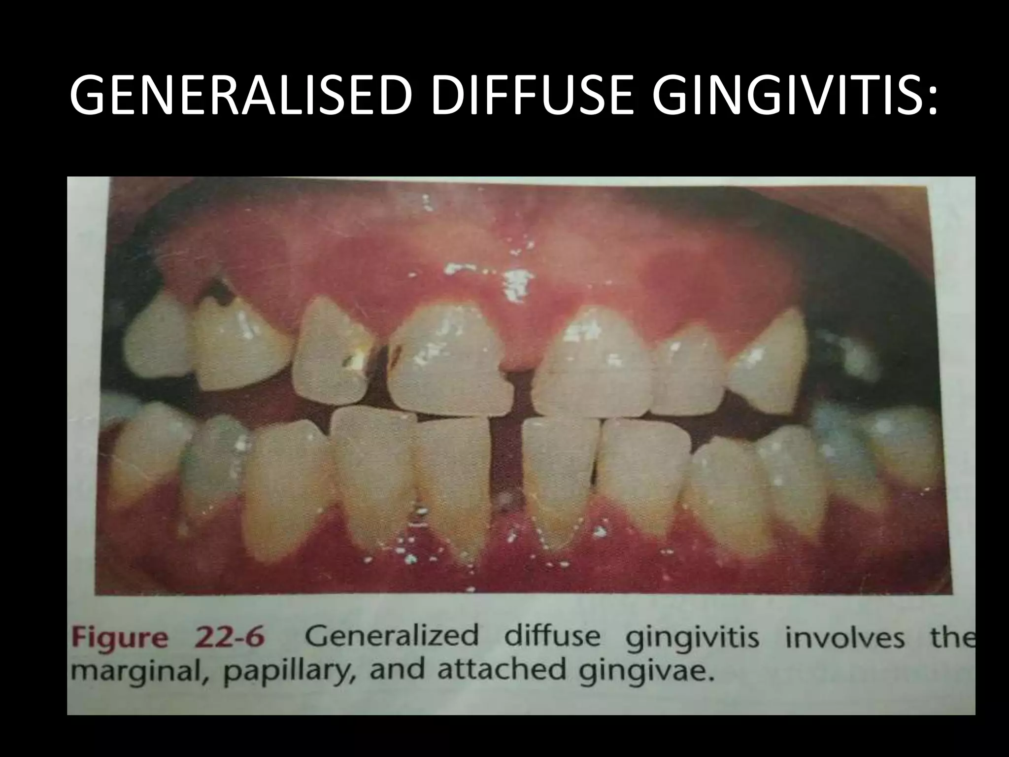 Clinical reatures of gingivitis | PPTX