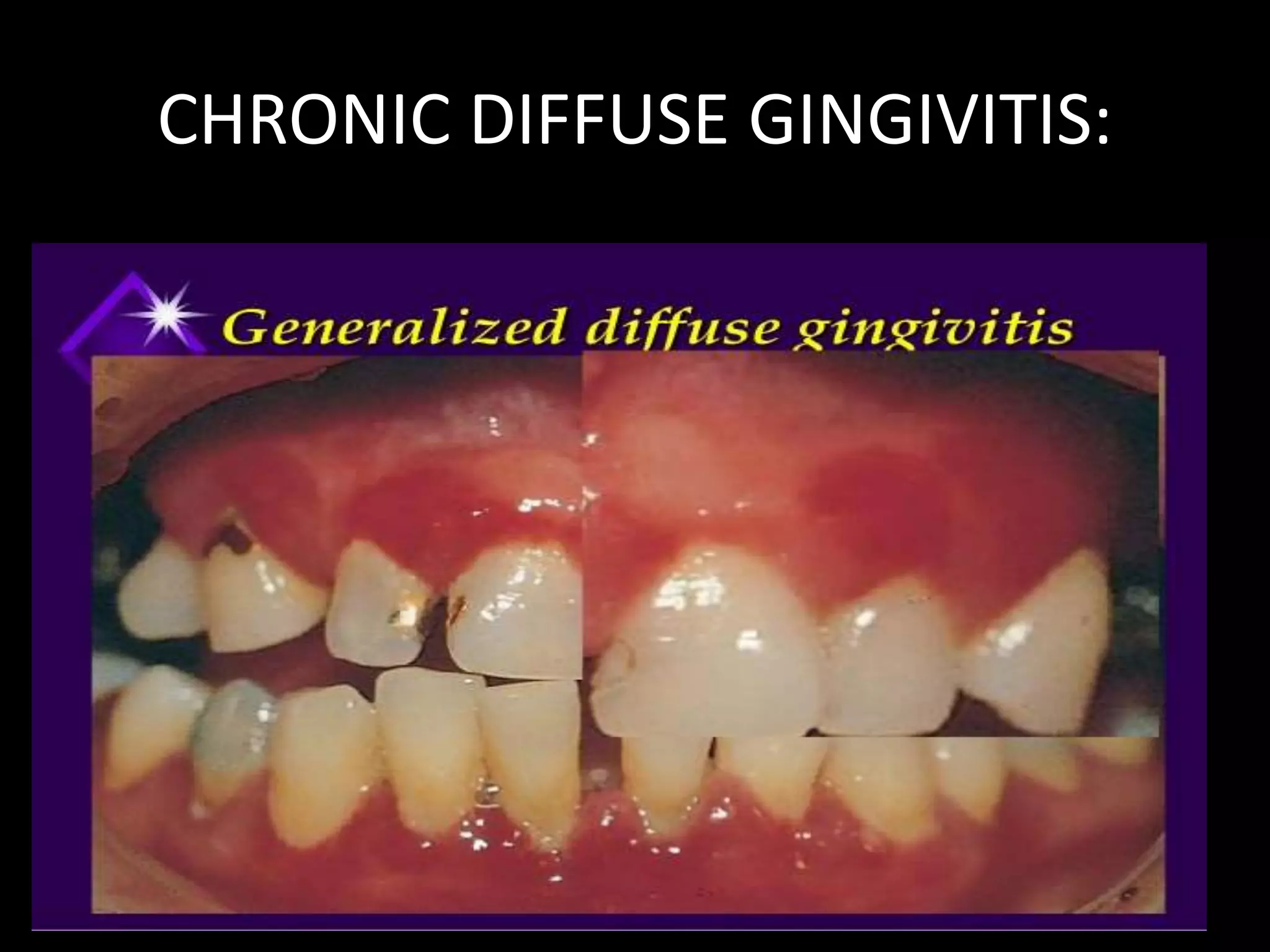 Clinical reatures of gingivitis | PPTX
