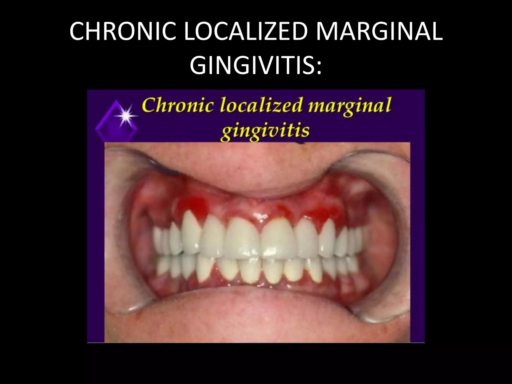 Clinical reatures of gingivitis | PPTX