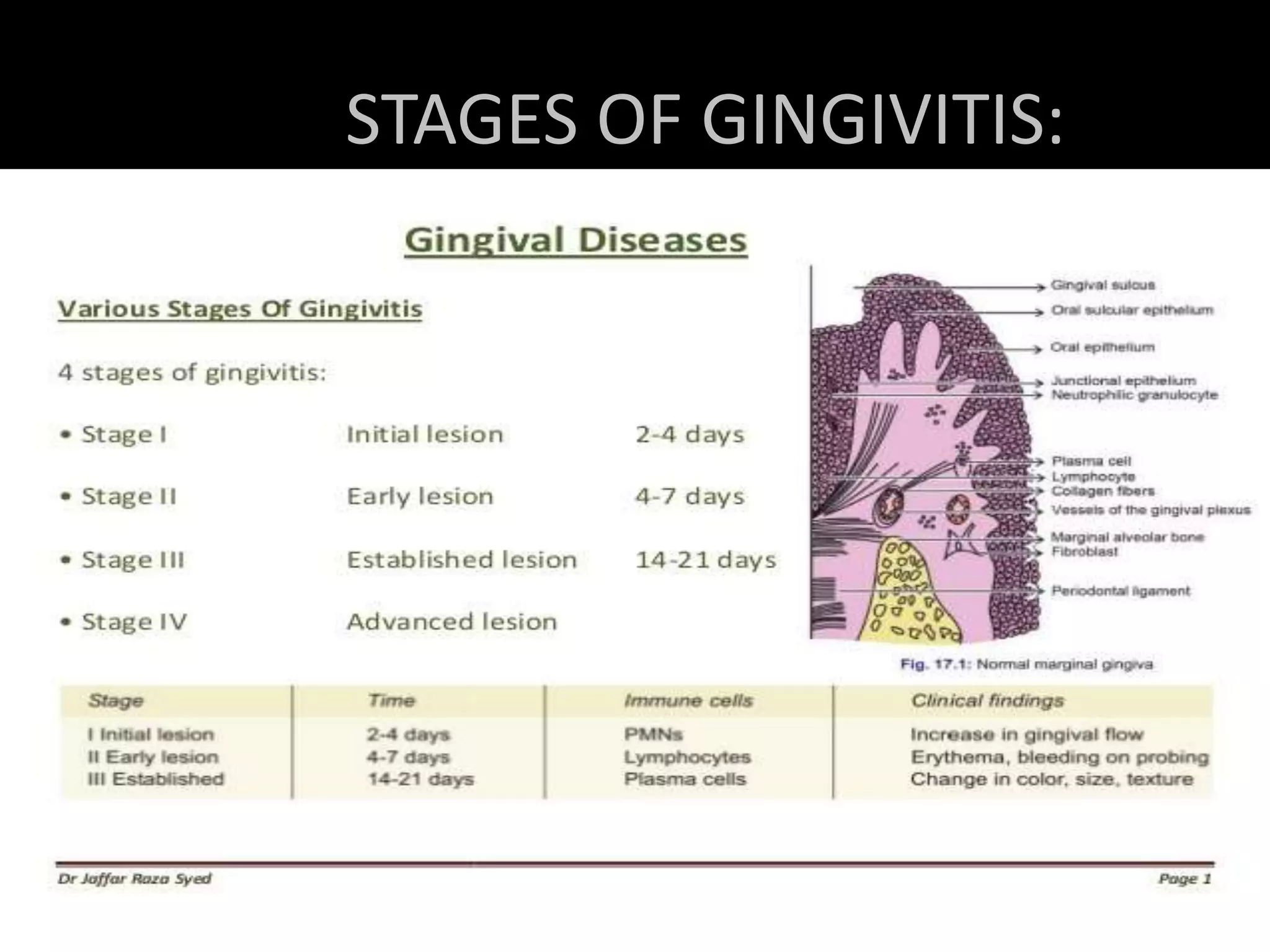 Clinical reatures of gingivitis | PPTX