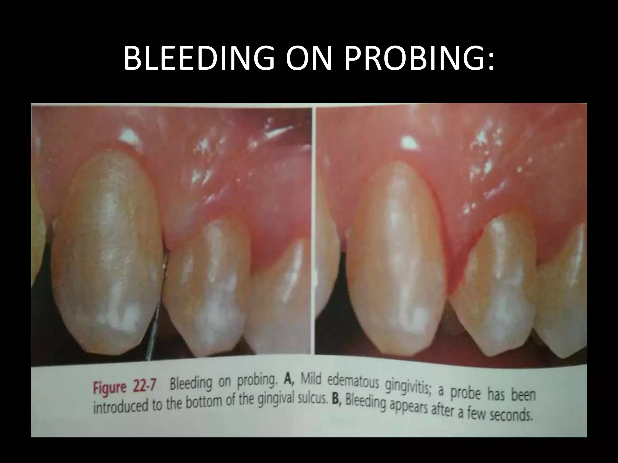 Clinical reatures of gingivitis | PPTX