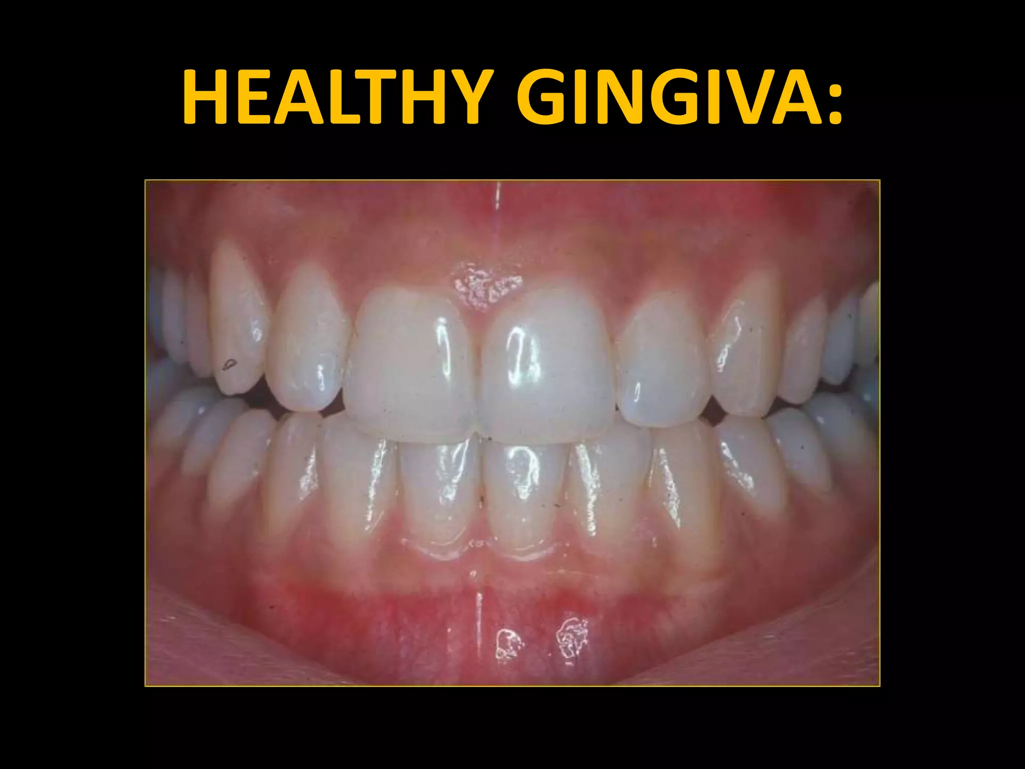 Clinical reatures of gingivitis | PPTX