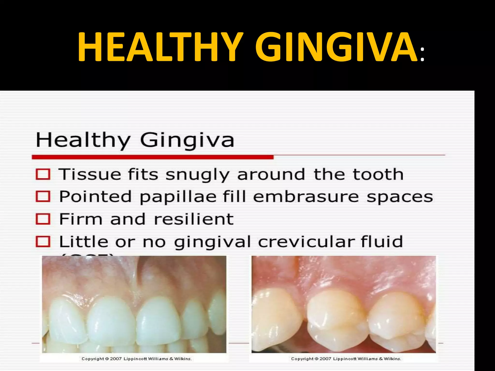 Clinical reatures of gingivitis | PPTX
