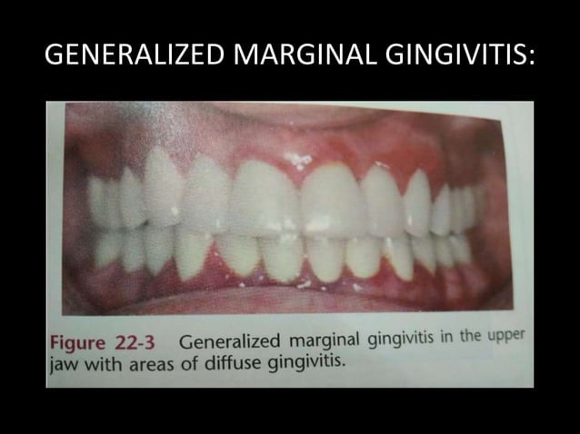 Clinical reatures of gingivitis | PPTX | Dental Health | Diseases and ...