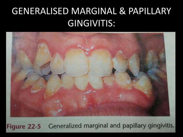 Clinical reatures of gingivitis | PPTX | Dental Health | Diseases and ...